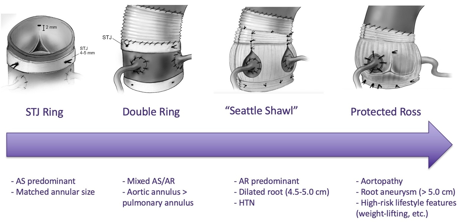 The Ross Procedure - UW Medicine Heart Institute